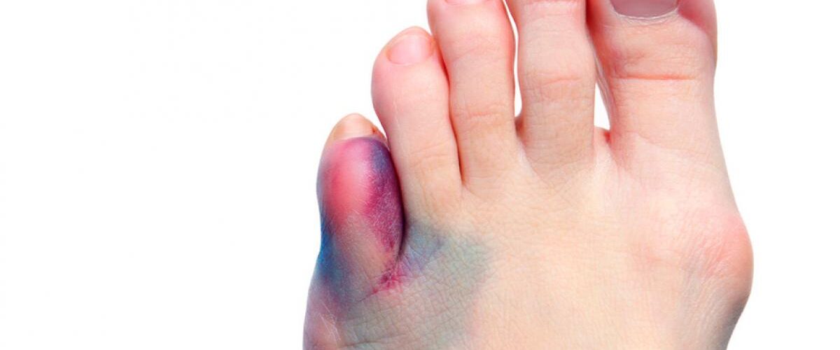 Fractured little finger: 1 treatment | Medical Pharma News | Modern ...